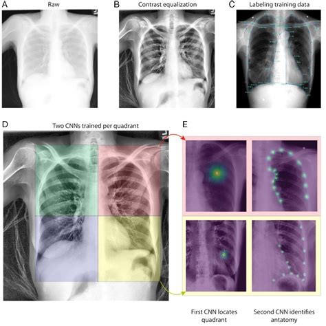 Dynamic Digital Radiography Pulmonary Function Testing Chest Pulmonary