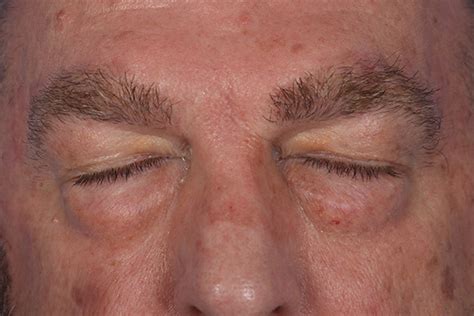 Blepharoplasty Case 4068 Dr Guy