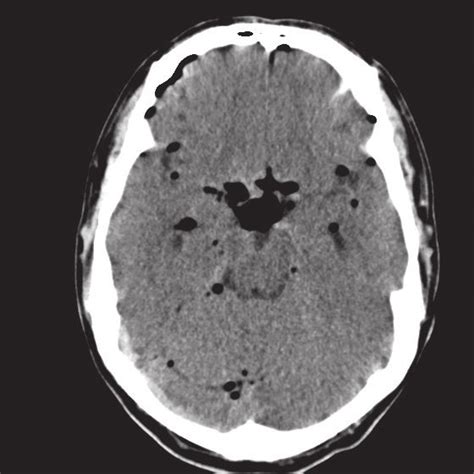 Ct Image Axial Projection Taken Approximately Two Hours After Download Scientific Diagram