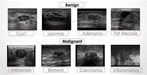 Inflammatory Breast Cancer Ultrasound