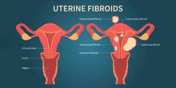 Enlarged Uterus Complications Causes And Treatments Pristyn Care