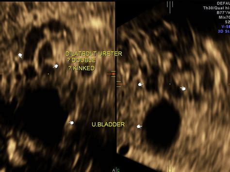 Bilateral Fetal Obstructive Uropathy Looking Through A Transducer