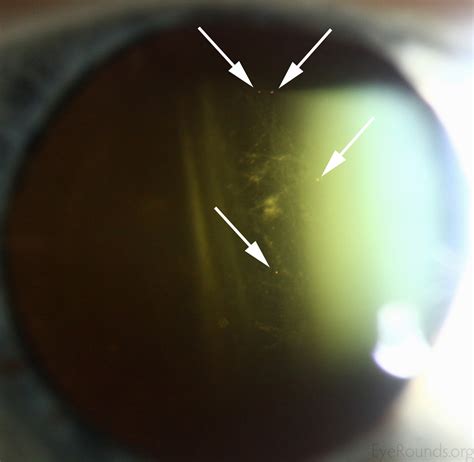 Vitreous Syneresis An Impending Posterior Vitreous Detachment Pvd
