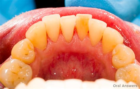 Calculus Teeth