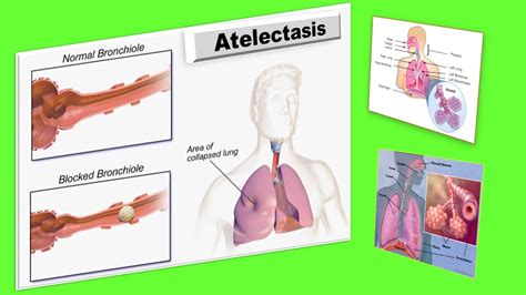 Lessons I Learned From Tips About How To Prevent Atelectasis Unfuture38