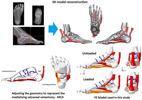 Medial Calcaneal Osteotomy