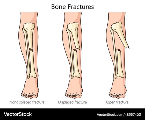 Closed Fracture