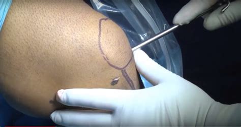 Acl Reconstruction Using Hamstring Graft —