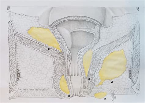 The Anatomical Definitions Of Anal Abscesses A Perianal B Low Download Scientific Diagram