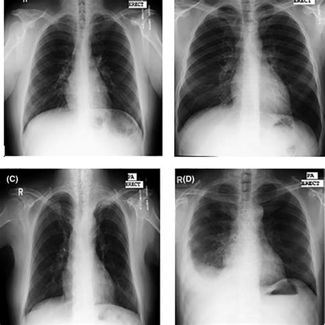 Pneumonia Tb Dataset Kaggle