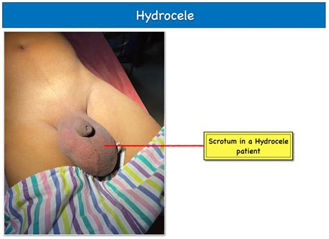 Hydrocele Clinical Features Pathophysiology Investigations