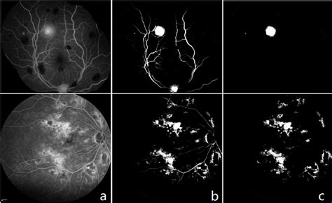 Figure 1 From Automated Retinal Lesion Detection Via Image Saliency