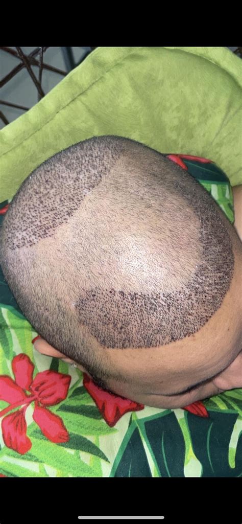 6 Months Post Ht In Dominican Republic R Tressless