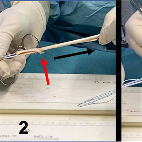 The Lasso Is Created By Passing The Proximal End Of The Tendon Red