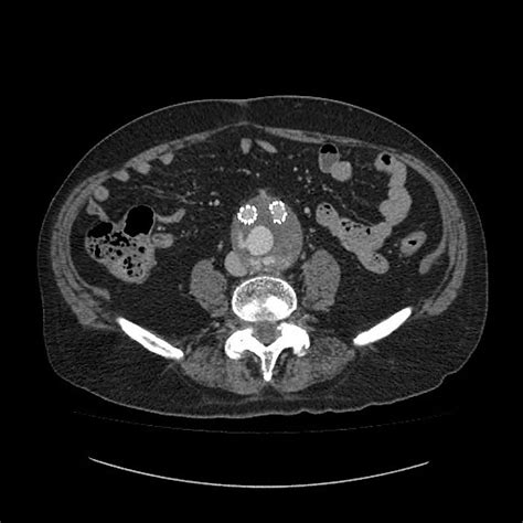 Endoleak Typ 2 Reperfusion Durch Nebengefäß Pacs