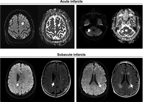 Frequency Of Acute And Subacute Infarcts In A Population Based Study Pmc