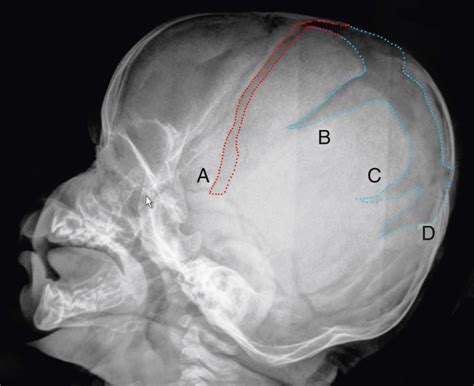 Multiple Suture Nonsyndromic Craniosynostosis Neupsy Key
