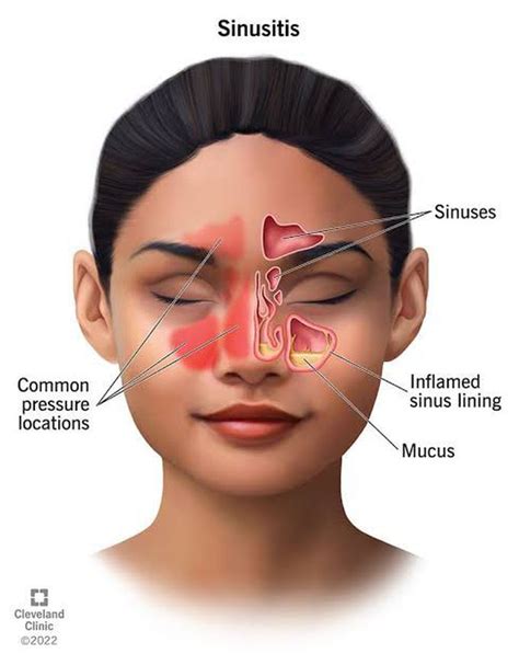 Treatment Of Sinusitis Medizzy