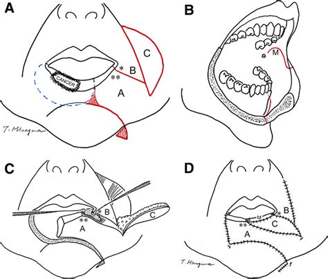 Schema Of Modified Webster Method A A B And C Denote The Flap