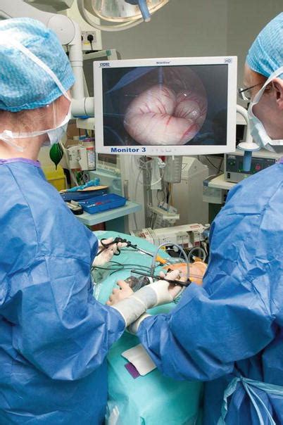 Laparoscopic Assisted Soave Pullthrough For Hirschsprung Disease Thoracic Key