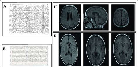 A Sleep Eeg Showing An Aspect Of Hypsarrhythmia High Amplitude And