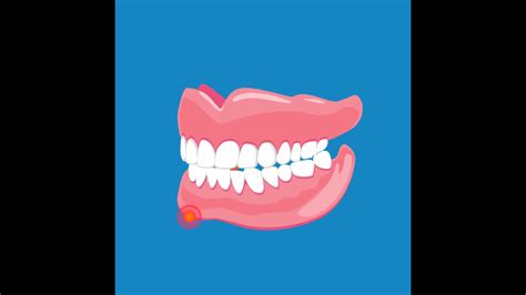 How To Spot The Signs Of Oral Cancer Youtube