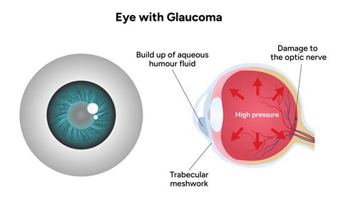 Not All Glaucoma Is The Same Understanding The Different Types