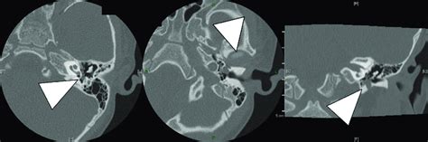 Pre Operative Temporal Bone Computed Tomography CT A Left Download Scientific Diagram