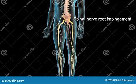 Spinal Nerve Root Impingement 3d Illustration Stock Illustration Illustration Of Formation