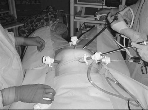 Photograph Of Port Placement For Sigmoid Colectomy Download
