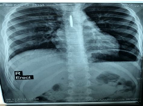 Coin Sagittal Orientation In Ap Erect Cxr Download Scientific Diagram