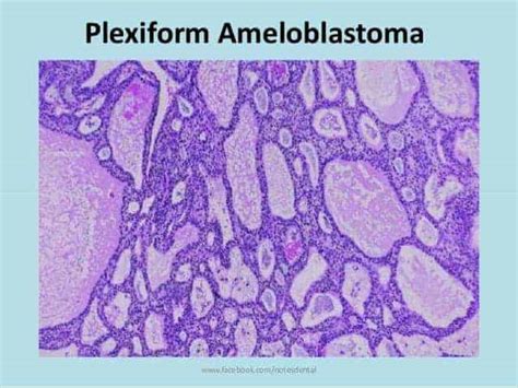 Plexiform Ameloblastoma Histology