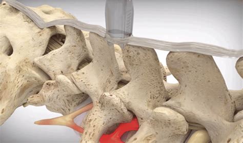 Vertiflex Procedure Airport Plaza Spine And Wellness The Best Care In Hazlet Nj 1