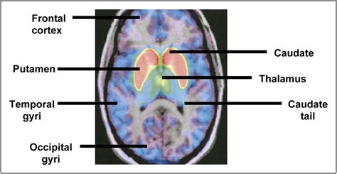 Schizophrenia Brain Vs Normal Brain