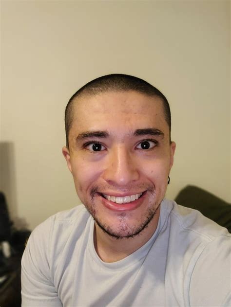 Thyroid Issues And Balding Rbald