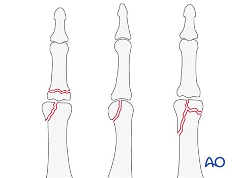 Midaxial Lateral Approach To The Proximal Interphalangeal Joint