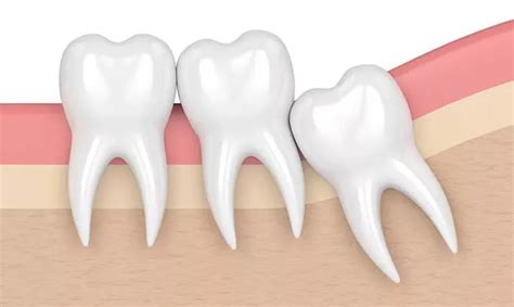 Impacted Tooth Removal Surgery In Kochi Kerala Dr Bobbys Dental Clinic