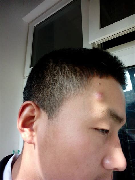 额头长包硬硬的凸起 额头长肉粒图片 伤感说说吧