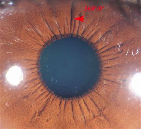 Modern And Multidimensional Iridology Radial Furrow At 360 In Modern