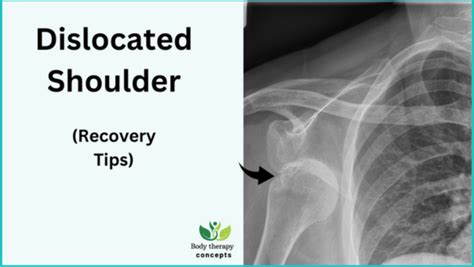 Dislocated Shoulder Healing Timeline Treatment And Rehab Tips