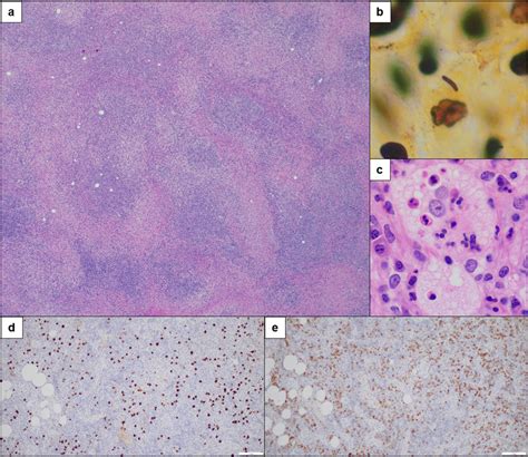 A Necrotizing Granulomatous Inflammation In An 11 Year Old Girl With Download Scientific