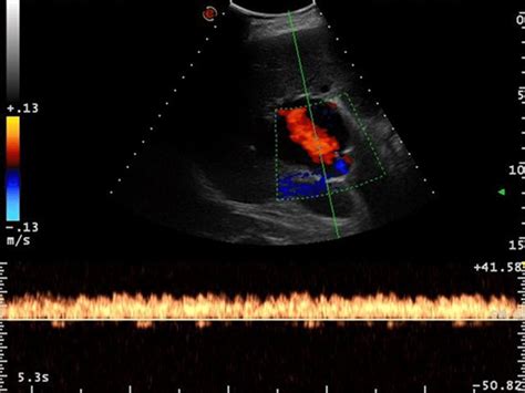 Pulsed‐wave Doppler Demonstrating The Presence Of A Monophasic