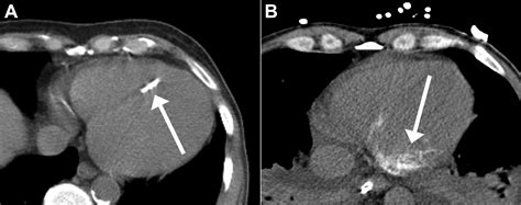 Myocardial Calcifications Pathophysiology Etiologies Differential Diagnoses And Imaging