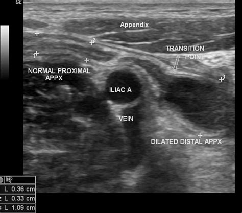 Medical Ultrasound Acute Appendicitis