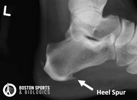 Heel Spur X Ray