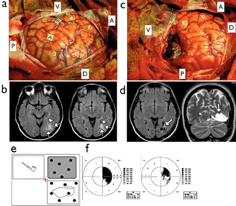 Intraoperative Subcortical Electrical Mapping Of Optic Radiations In Awake Surgery For Glioma