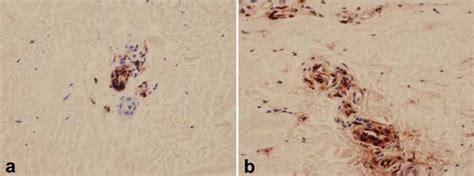 Immunohistochemical Staining Of Skin Tissue From A Single Aiu Patient