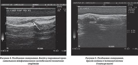 Сучасні можливості артросонографії в індивідуалізації лікувальних програм хворих на ревматоїдний
