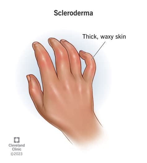Scleroderma Symptoms Causes And Treatment Options