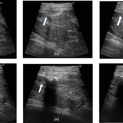 Identifying The Ventrogluteal Injection Region Download Scientific Diagram